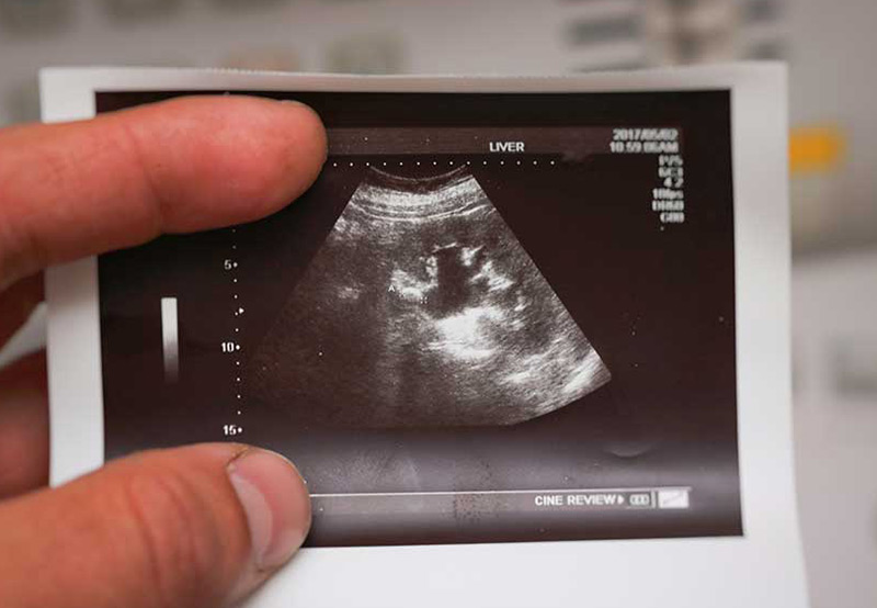 Ureteral Duplication - Dr. Heidi Stephany