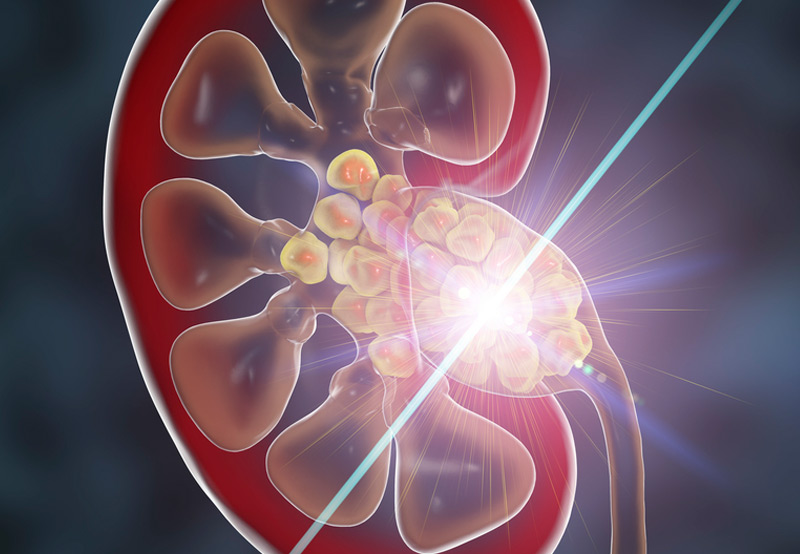 Kidney Stones - Dr. Heidi Stephany