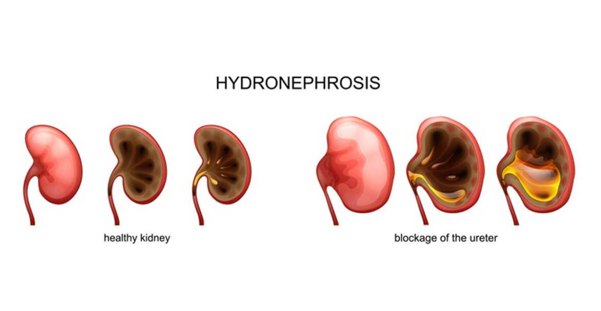 Hydronephrosis - Dr. Heidi Stephany