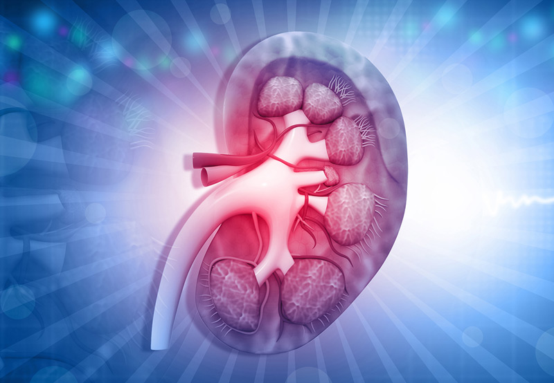 Ureterovesical Junction Obstruction - Dr. Heidi Stephany