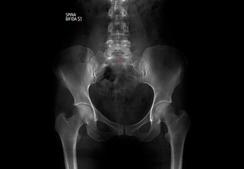 Spina Bifida - Dr. Heidi Stephany